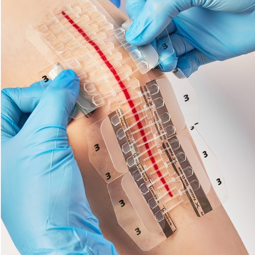 Foldable Skin Closure