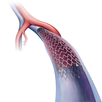 Venovo™ Venous Stent System